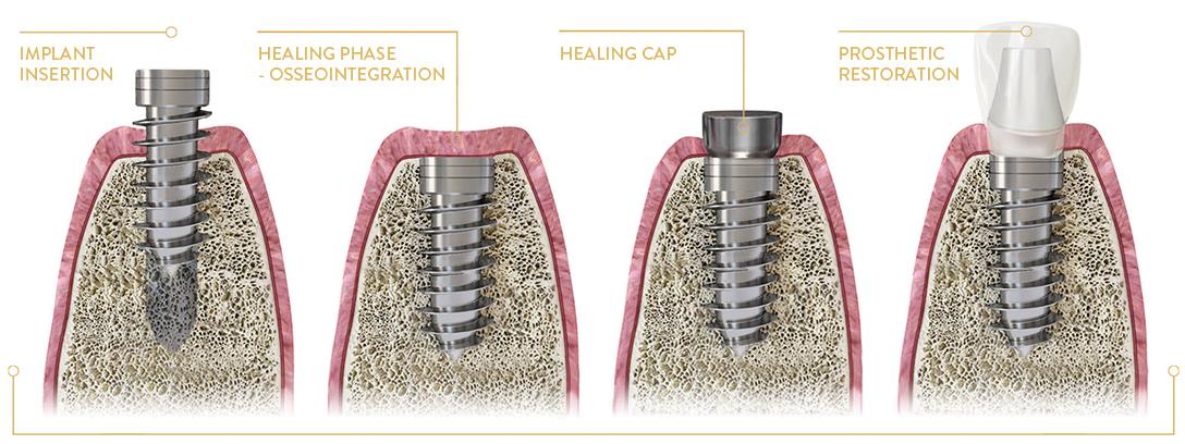 Dental Implants - The Oral & Maxillofacial Surgery Specialists of New York