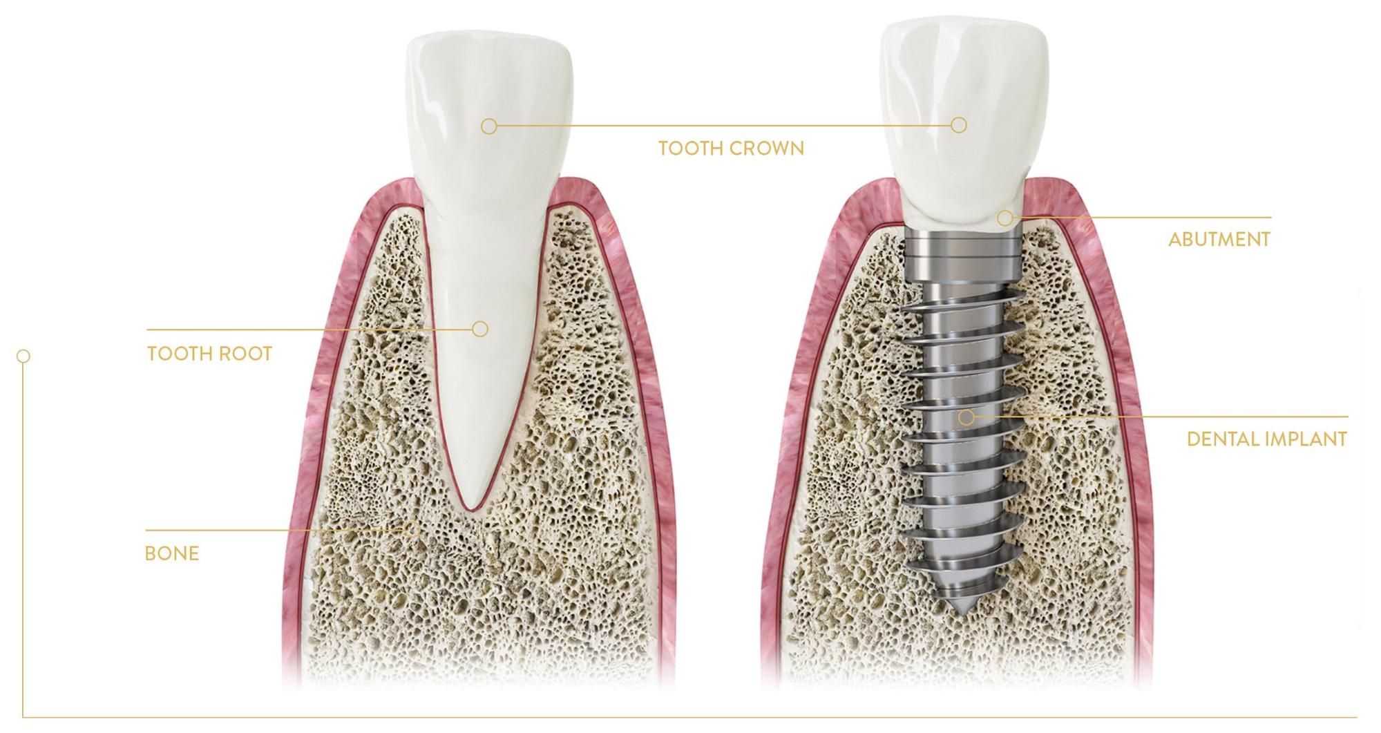 Dental Implants - The Oral & Maxillofacial Surgery Specialists of New York