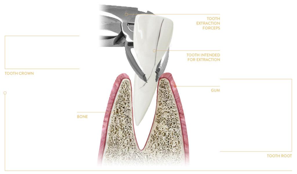Surgical Extraction - https://oralsurgeryspecialistsofny.com/